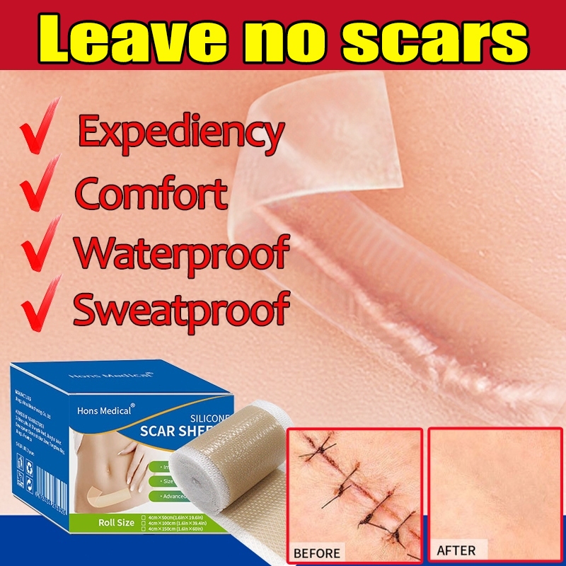 Silicone Scar Removal Patch Scar Sheet 4cmx50cm Scar Removal Patch ...