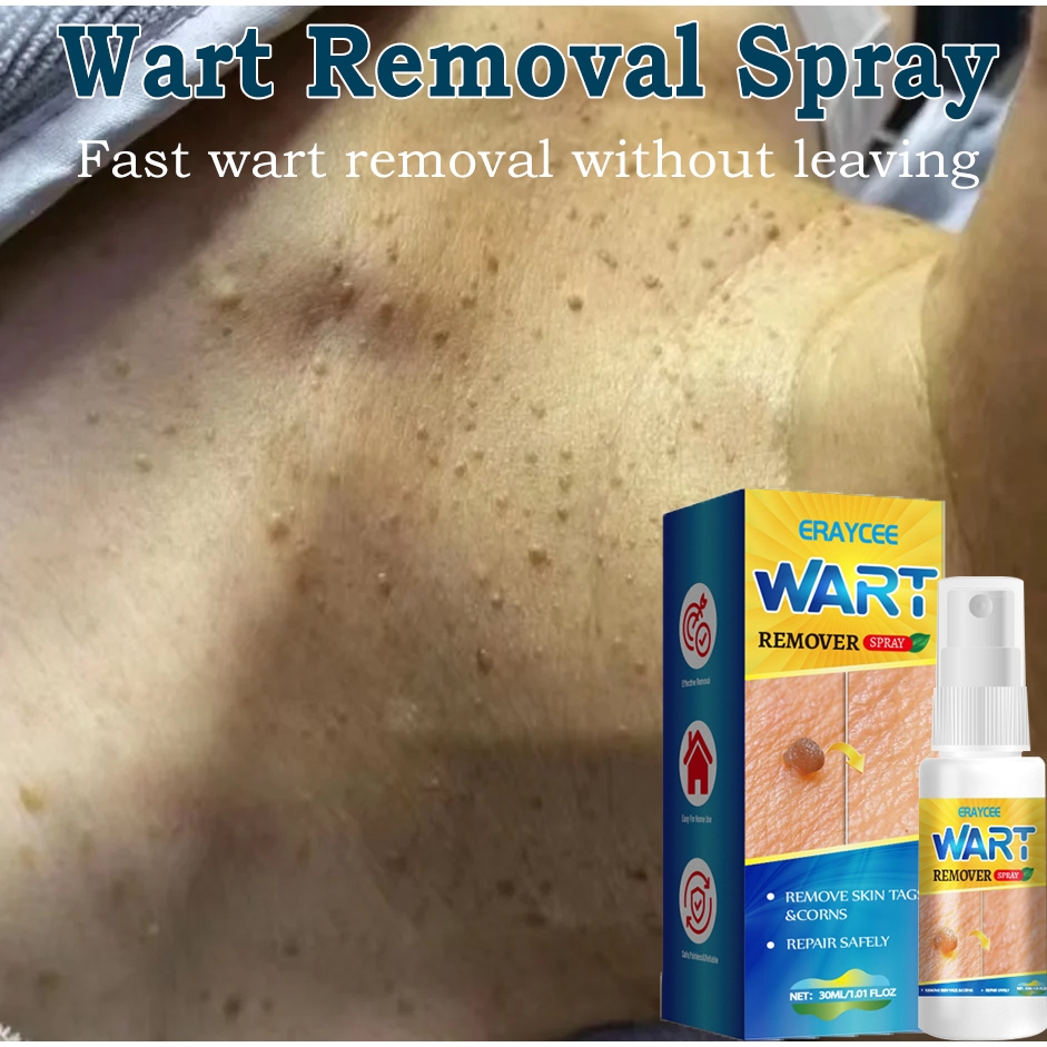 Wart Removal Spray, Warts Skin Tags Remover, Painless Rapidly removes ...