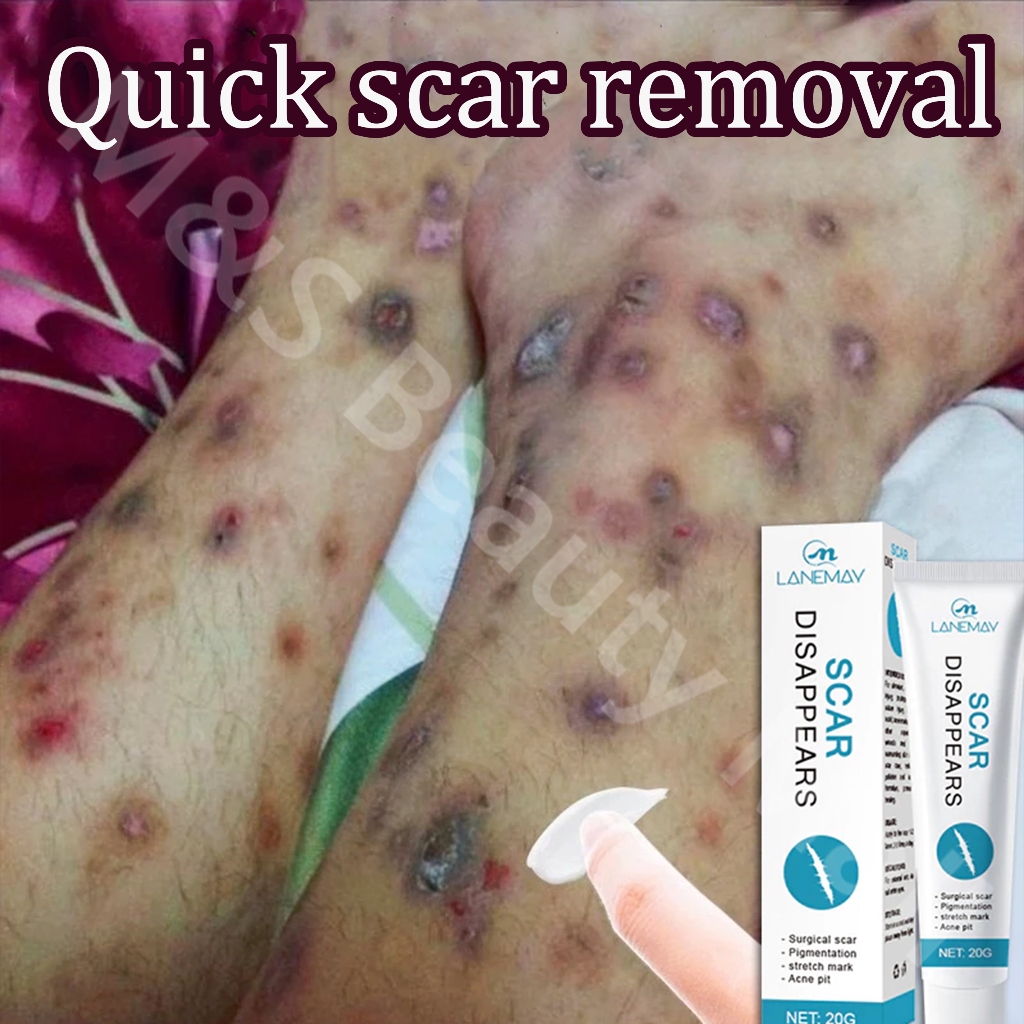 Scar repair cream 20g quickly removes scars, dilutes melanin scars ...