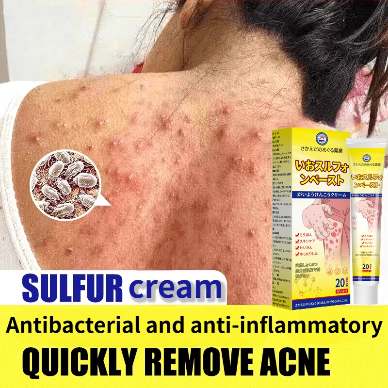 Antibacterial Sulfur Cream Eczema TreatmentAntibacterial Skin Fungal ...