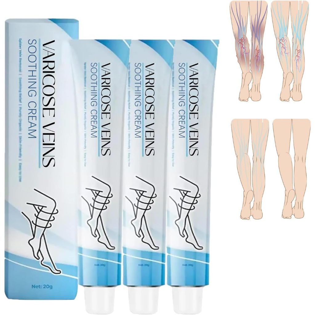 OUHOE Varicose Veins Treatment Cream-Varicose Veins Cream, Varicose ...