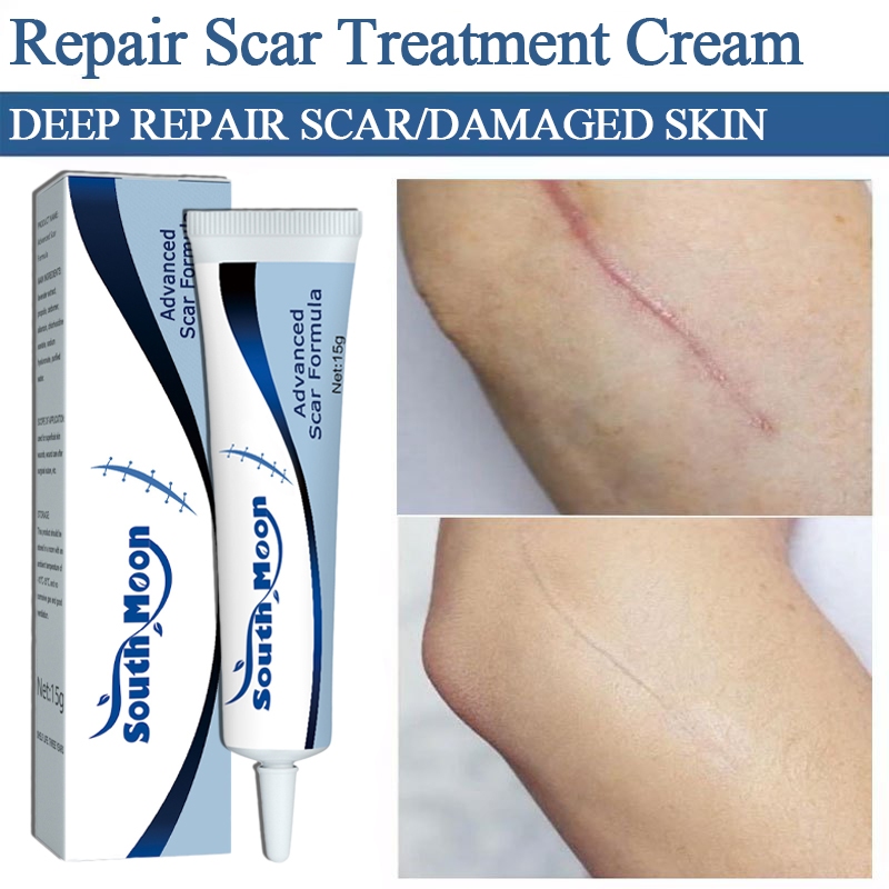 [South Moon] Scar Removal Cream and Scar Removal Gel Perfect removal of ...
