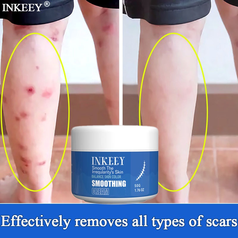 【Men, Women ＆ Children】Scar Removal Cream, Lighten Scars, Quickly ...
