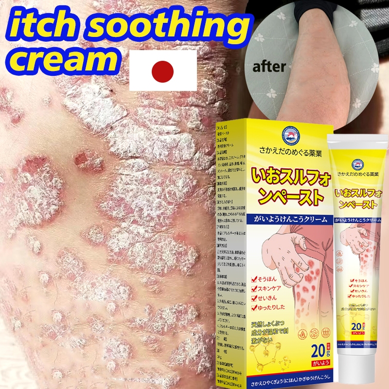 Eczema Cream psoriasis cream 20g anti itch cream Japan Sulfur Eczema Antifungal Cream for itchy ...