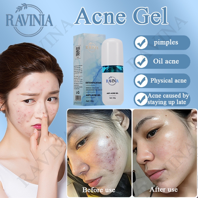 acne cream pimple cream acne scar removal 30g Anti-inflammatory ...