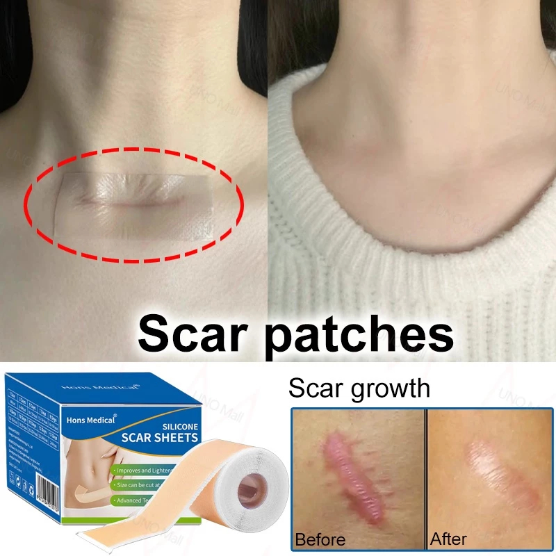 Scar Removal Medical Silicone Scar Sheet 4cmx50cm Scar Gel Keloid Scar ...