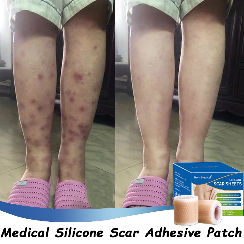 Medical silicone scar removal sheet 4cm×50cm, scar removal patch ...