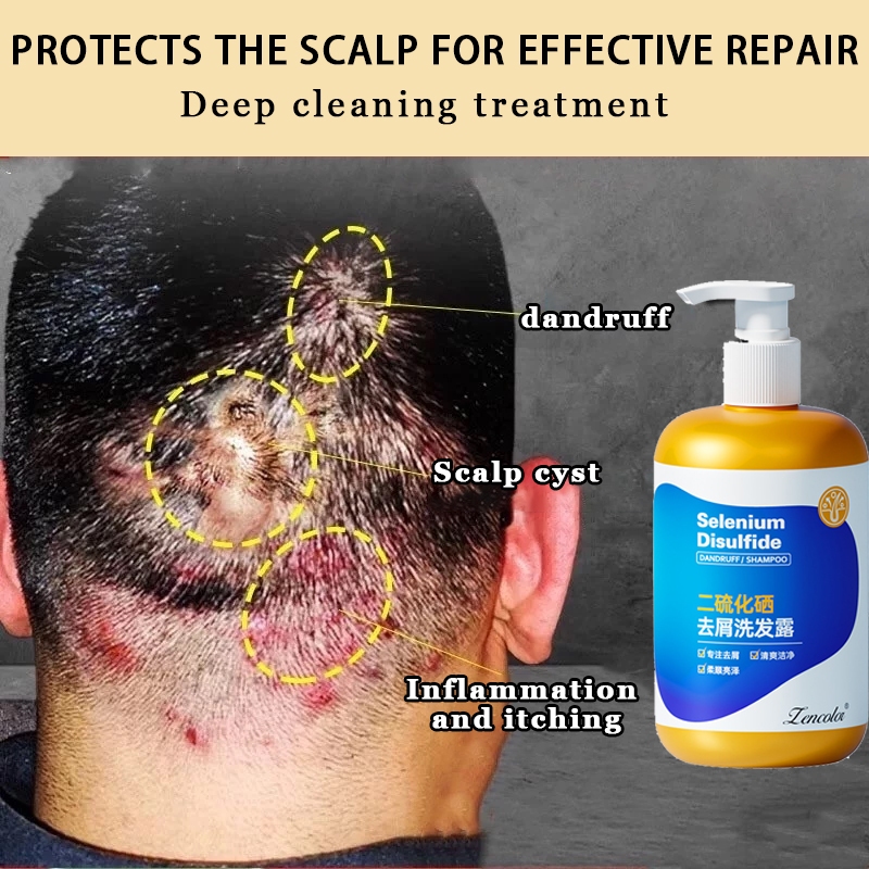 Seborrheic folliculitis shampoo 300ml, scalp redness, abscess, severe ...