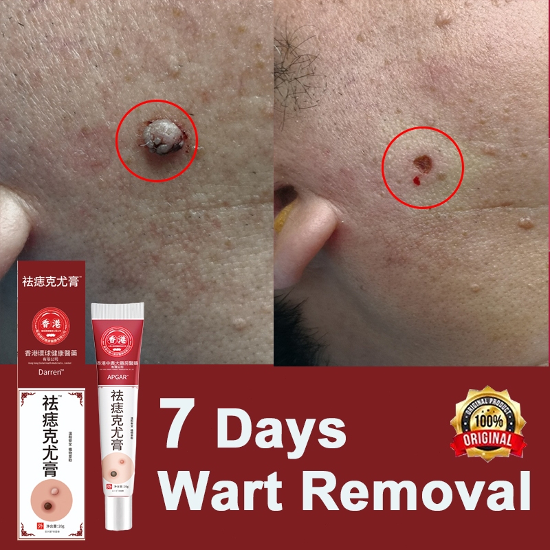 Wart Removal Cream skin tag remover 20g Painless Rapidly removes moles ...