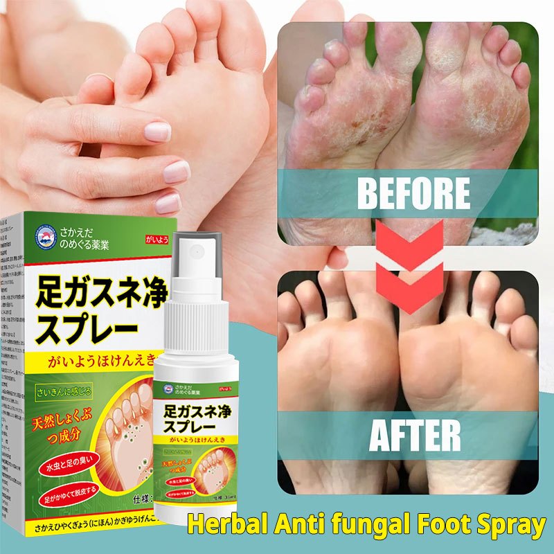 Herbal Anti fungal Foot Spray 35ml feet deodorant spray Remove Itchy ...