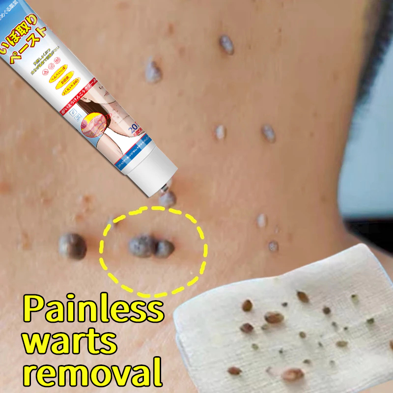 Japan Wart Removal Cream 20g Mole Remover Mole Skin Tag Remover ...