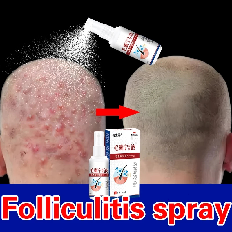 Folliculitis Hair follicle nourishing essence for hair growth ...