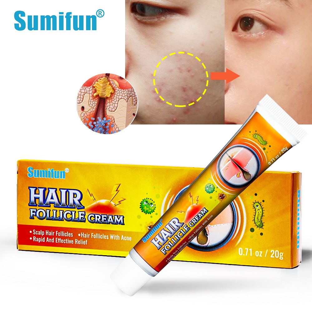hair follicle cream Seborrheic dermatitis cream scalp treatment ...