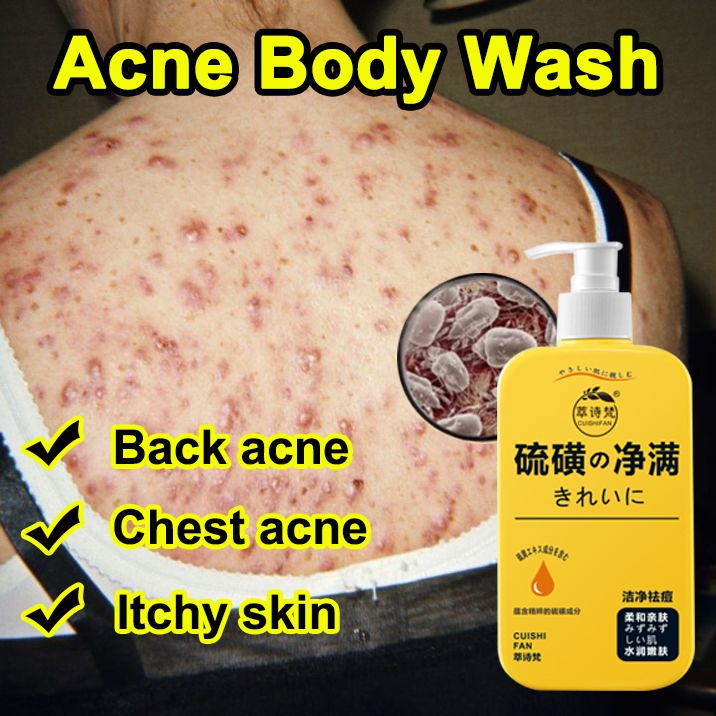 Sulfur Acne Body Wash Back Acne body Wash 300ML Calming Acne Clear Body Wash Deep Clean ...