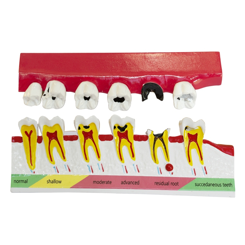 Tooth Model Doctor Patient Communication Teaching Tooth Classification ...
