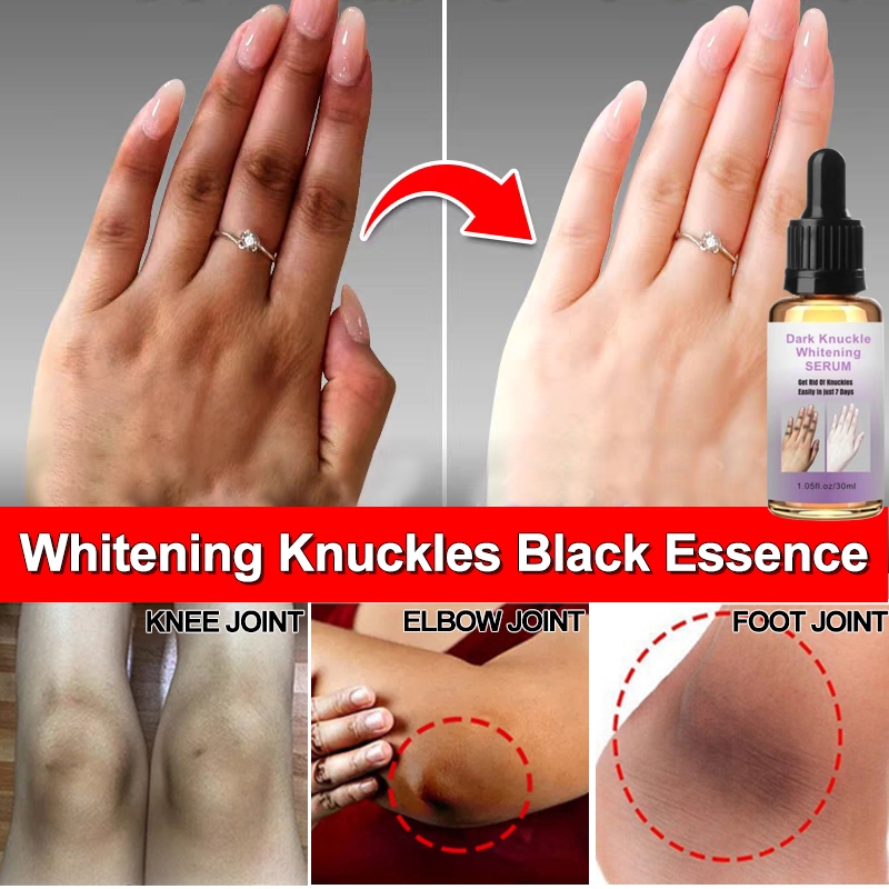 Knuckle elbow knee whitening serum 30ml joint melanin removal light ...