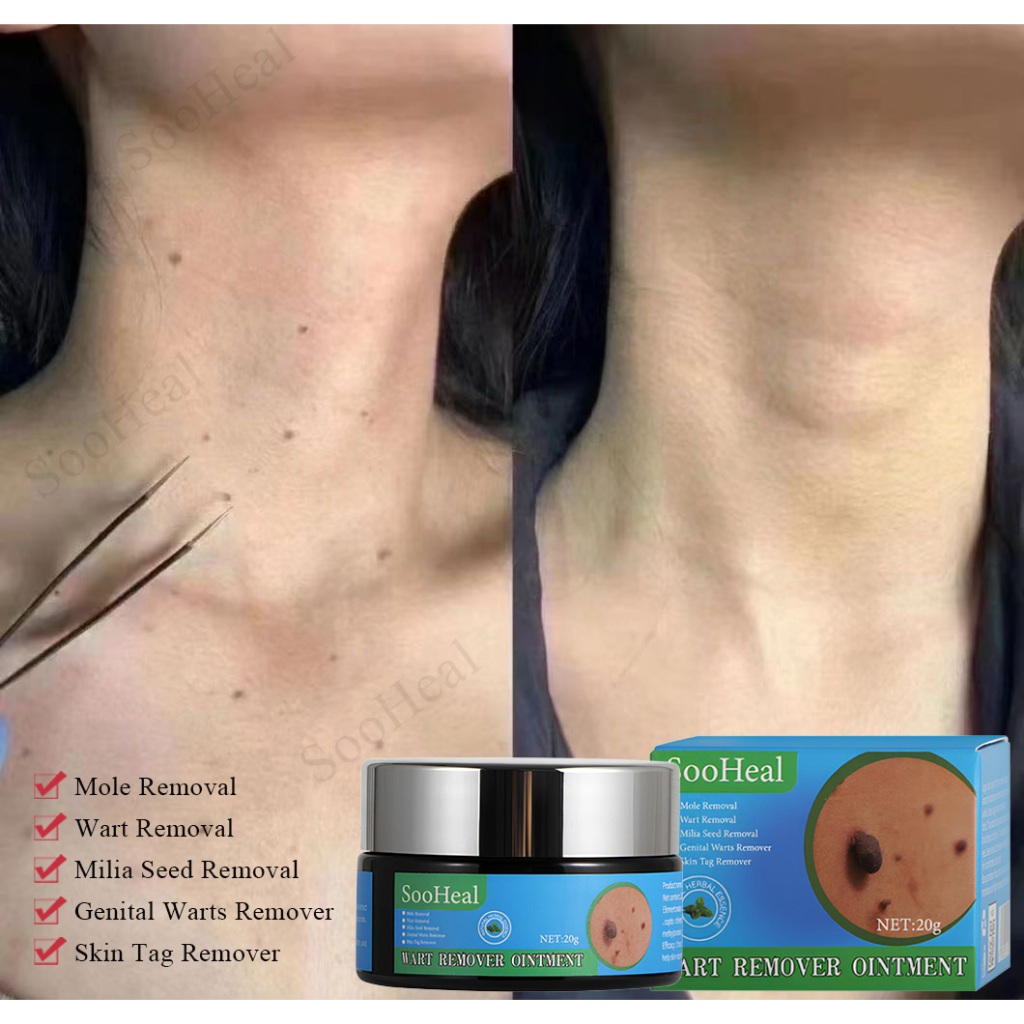 mole removal wart removal skin tag remover 20g Safe and painless wart ...