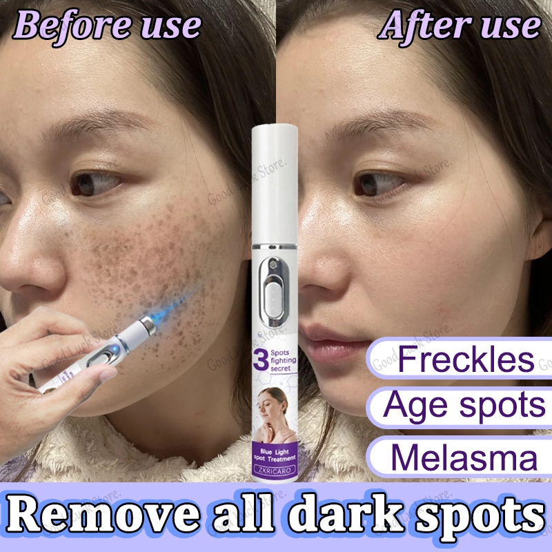 Eliminates 99.99% of pigmentation dark spot remover Freckle removal ...
