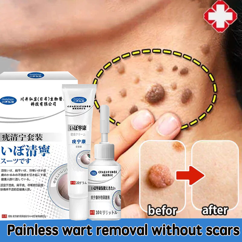 skin tags remover wart removal cream 20g+10ml mole remover skin tag ...