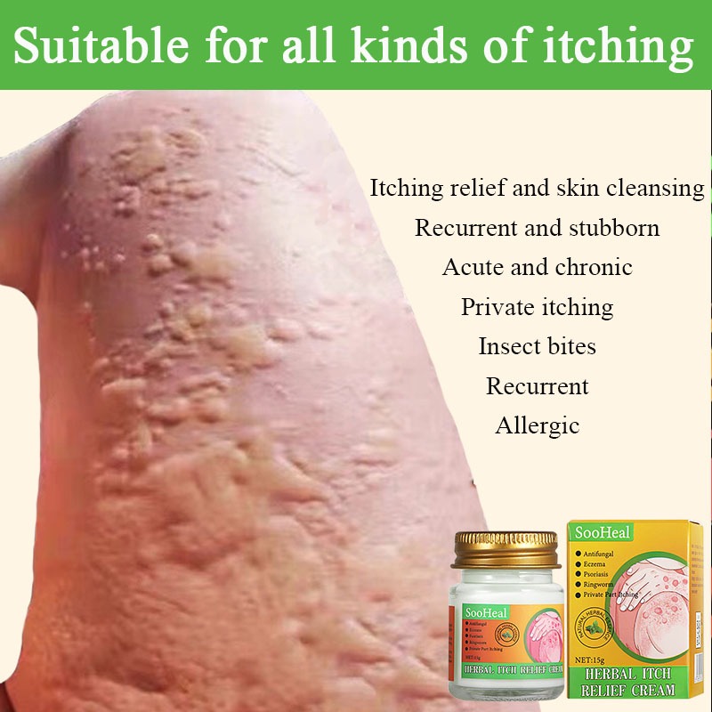 Anti-itch cream antifungal cream eczema cream 15g Psoriasis fungal ...