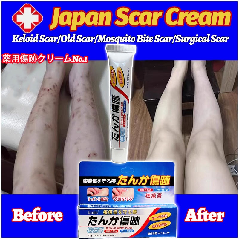 Japan Advanced Scar Removal Cream 20g Keloid Scar Removal Efficient ...