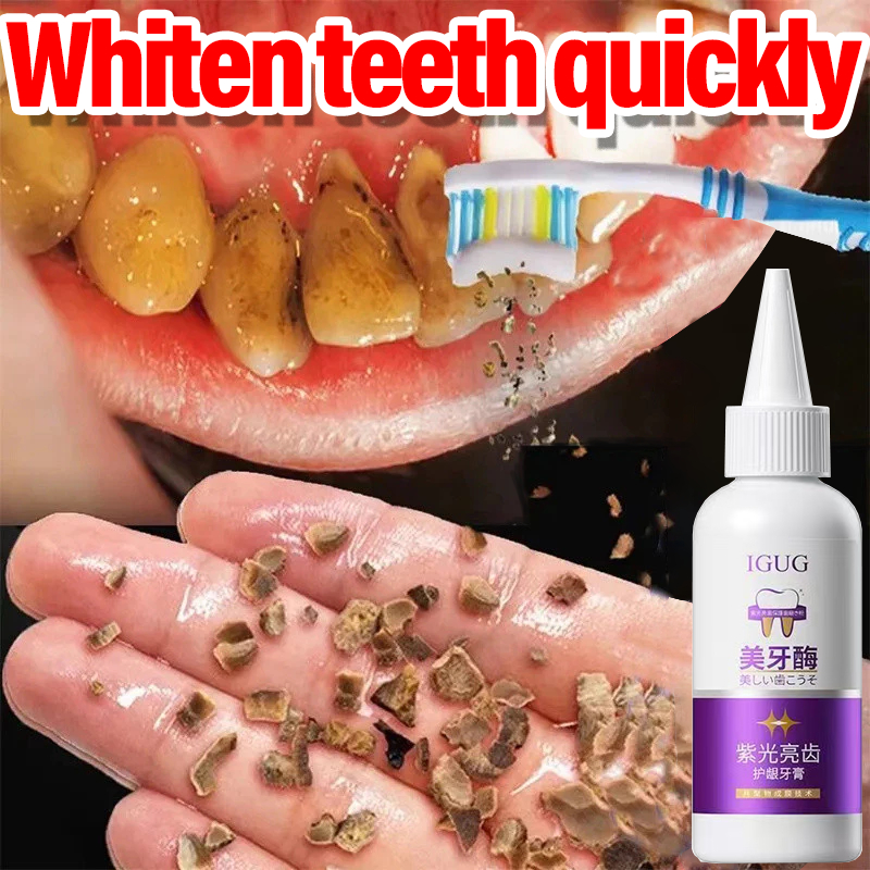 【SG Shipping】 Remove yellow teeth stains, smoke stains, remove dental ...