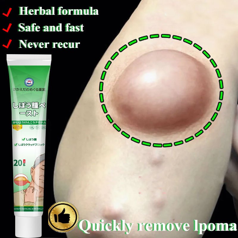 lipoma removal cream 20g Remove Body Lumps Thyroid Lumps Lymph Nodes ...