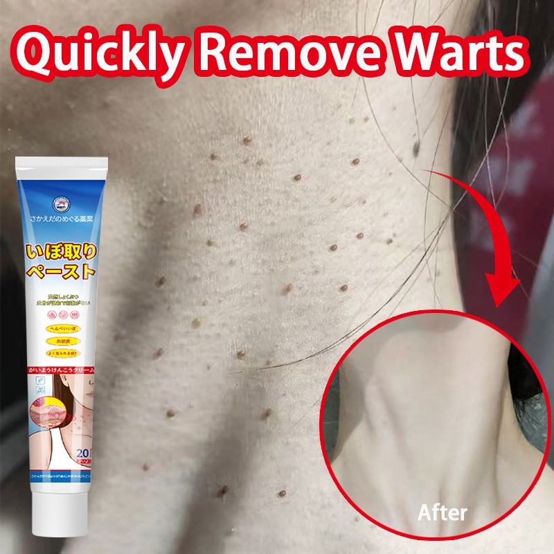Wart Removal Cream 20g Skin Tag Remover Remover flat warts common warts ...