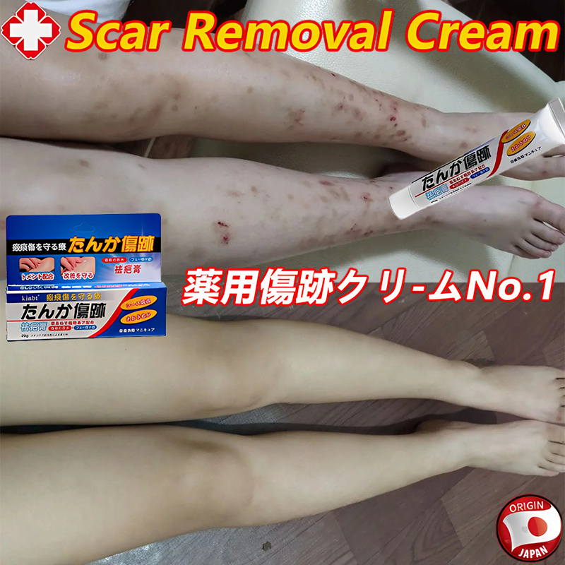 Japan Scar Removal Cream 20g Removes Black Scars/ Insect Bite Scars ...