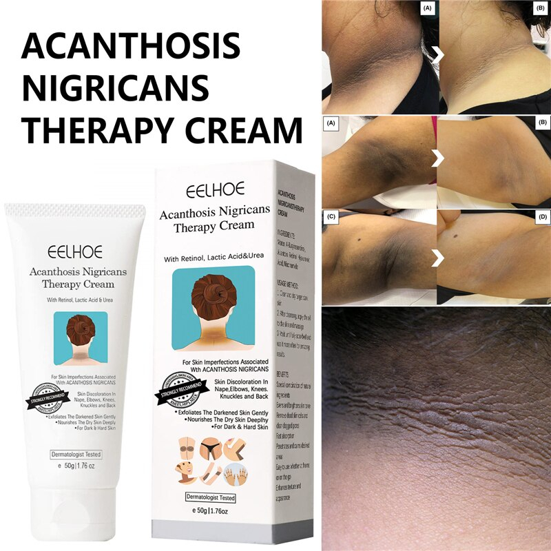 EELHOE Acanthosis Nigricans Therapy Cream Whitening Body Spray Removal ...