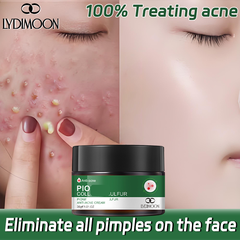 LYDIMOON Acne cream Acne scar Removing cream 30g Treat acne and fade ...
