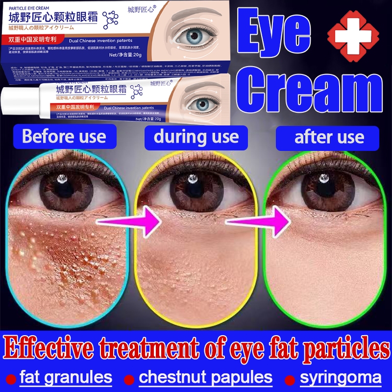 Eye Cream 20g eye Milia Seed Remover Cream--Fat Granule Syringoma Milia ...