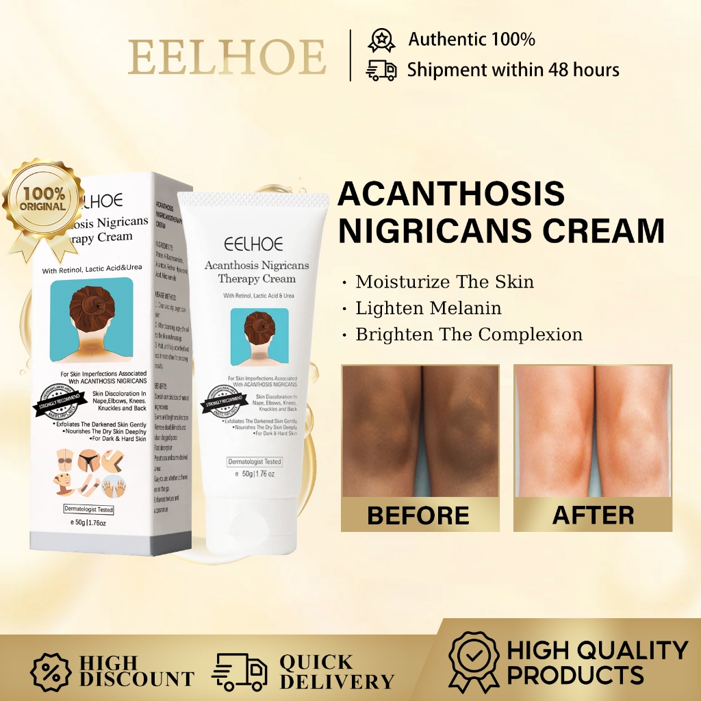 EELHOE Acanthosis Nigricans Therapy Cream 50g Armpits Joint Whitening ...