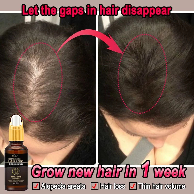 Hair growth serum Anti hair loss 30ml Hair thickener Tonic,Restore ...
