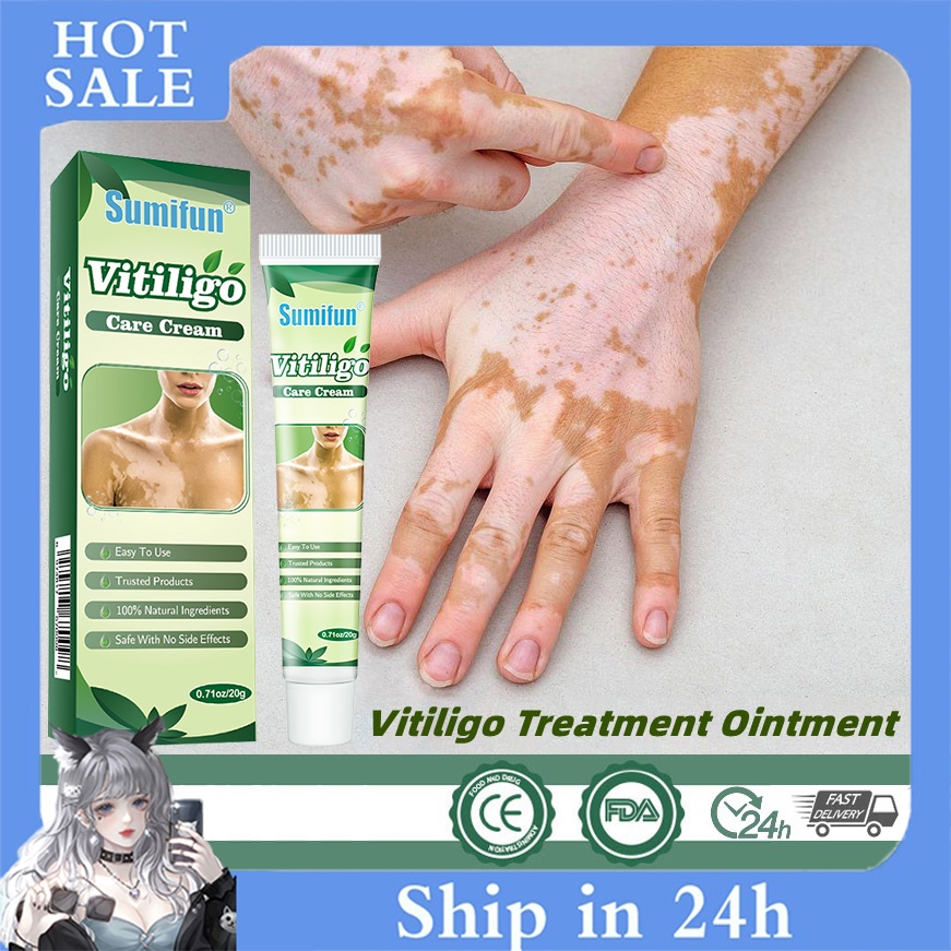 Vitiligo Cream Vitiligo Treatment Ointment Regulating & Improve White ...