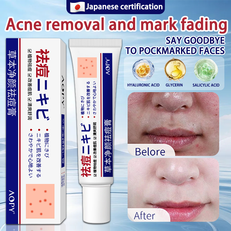 Acne scar removal Herbal Clearing Acne Cream for Facial Acne, Acne scar ...