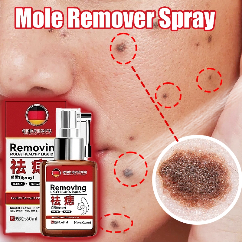 Mole Removal Spray Wart&Skin Tag Remover No Trace Mole Remover Rapidly ...