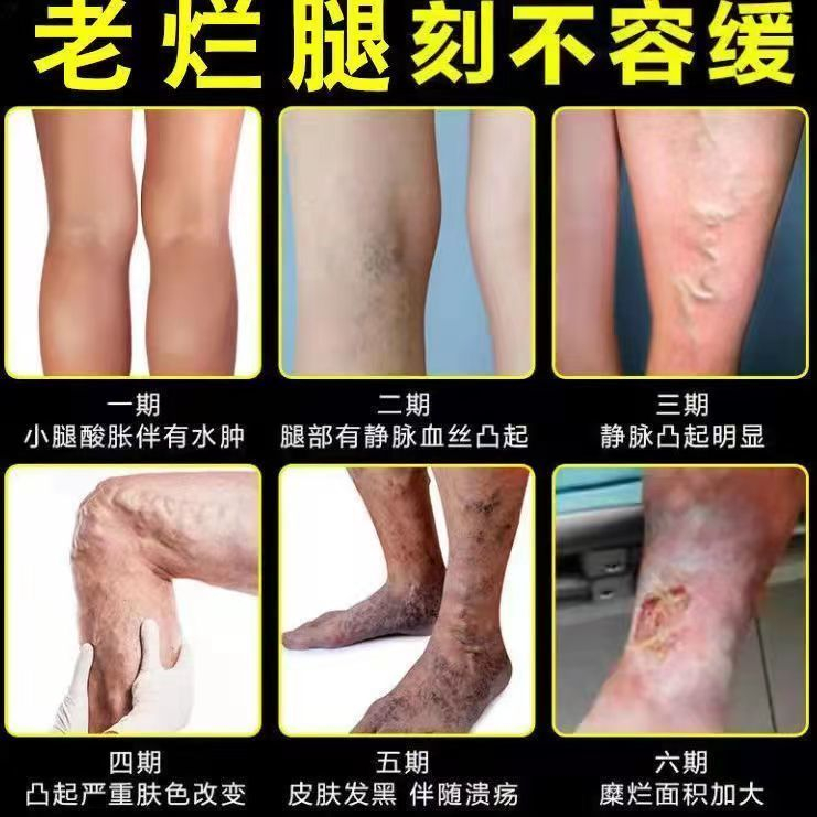 Trauma antibacterial solution 100ml Rapid wound healing scabbing rotten ...