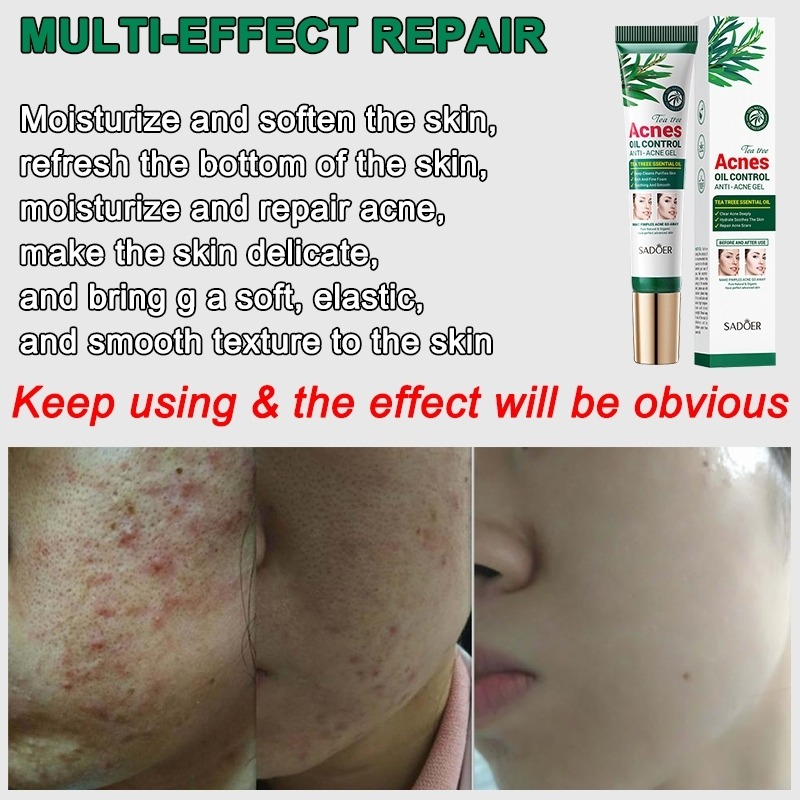 【Ready Stock】Effective Acne Removal Cream Acne Treatment Fade Acne ...