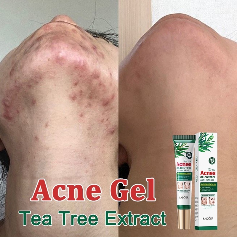 【Ready Stock】Effective Acne Removal Cream Acne Treatment Fade Acne ...