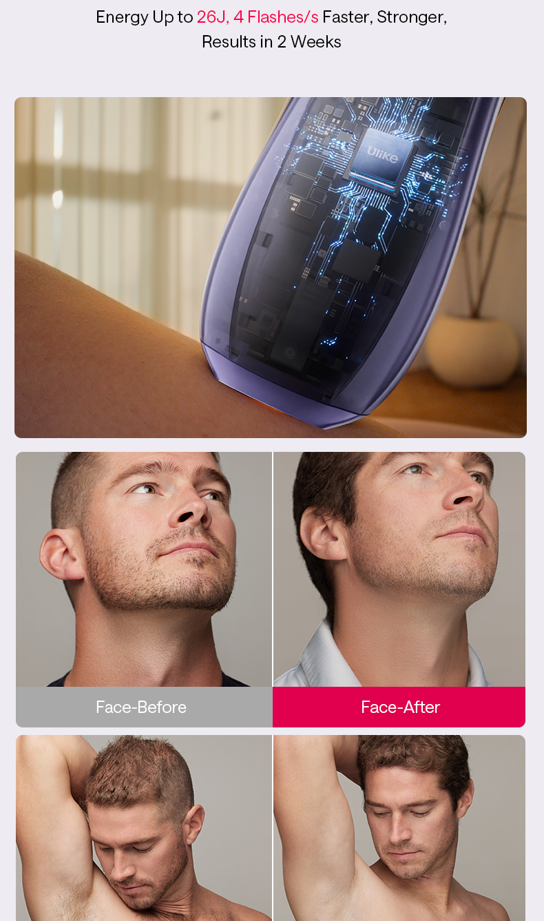 Ulike Air 10 Pro Ice Cooling IPL Hair Removal Device with Dual Lights ...