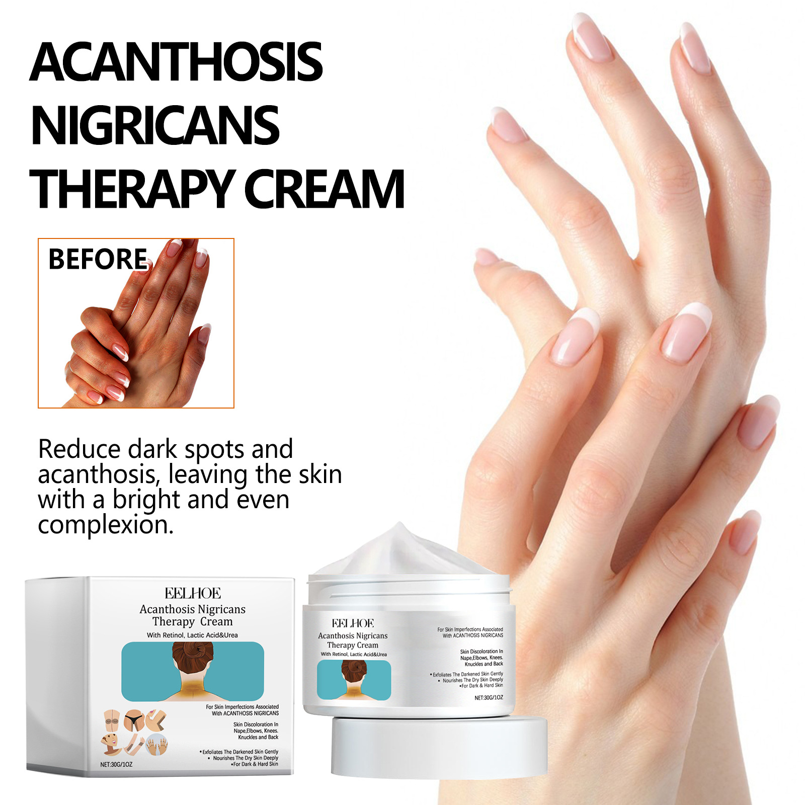 Acanthosis Nigricans Therapy Cream Whitening Body Spray Removal Of ...