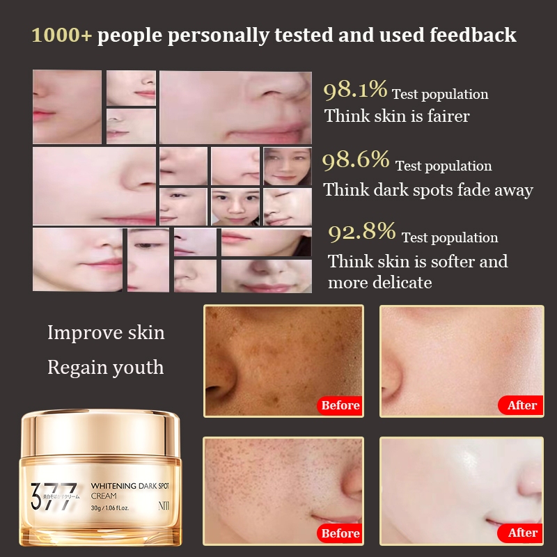 Whitening Freckle Remover Cream 377Whitening Spots Cream Niacinamide ...