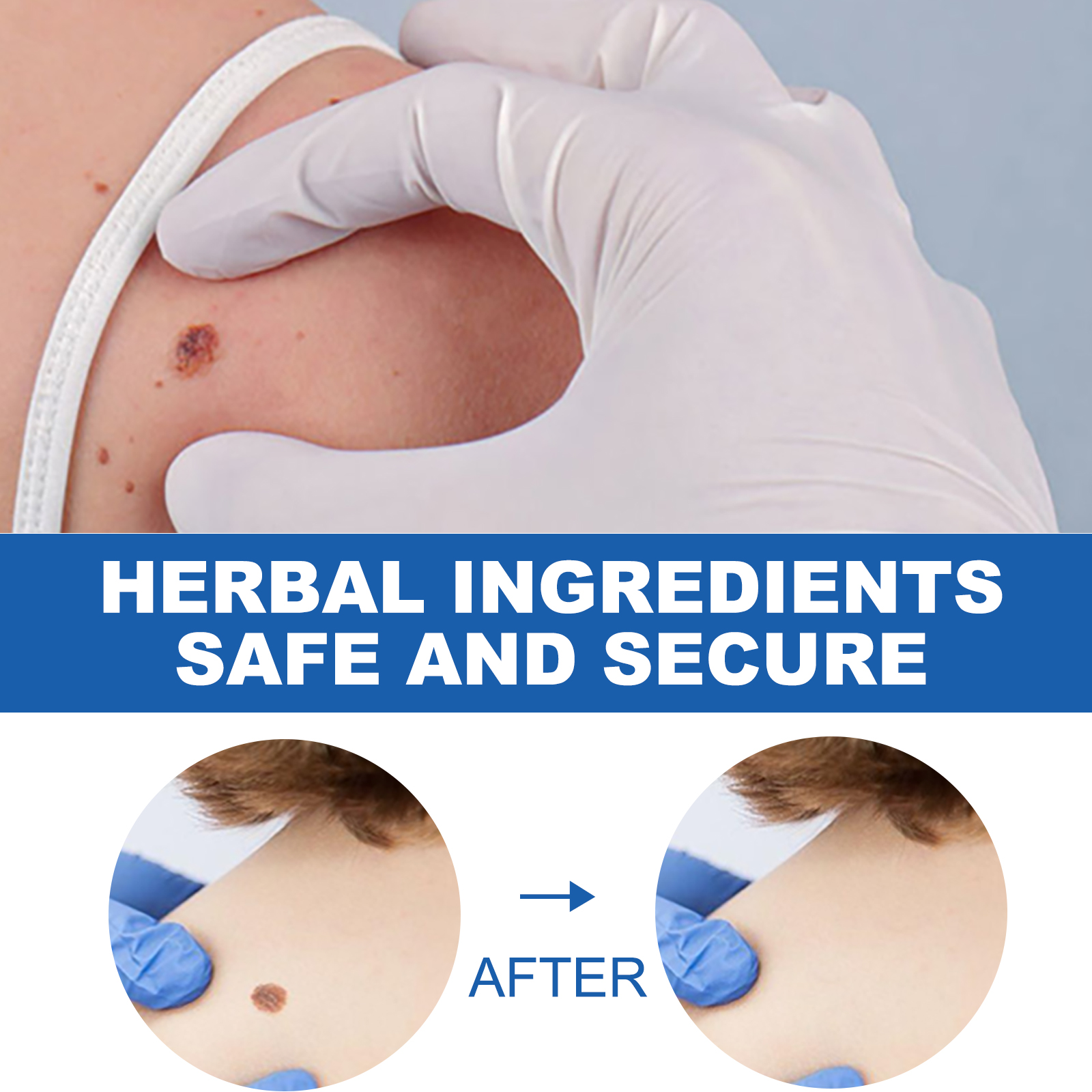 Warts Removers Warts And Skin Tag Removers Warts Ointment Warts Magic ...