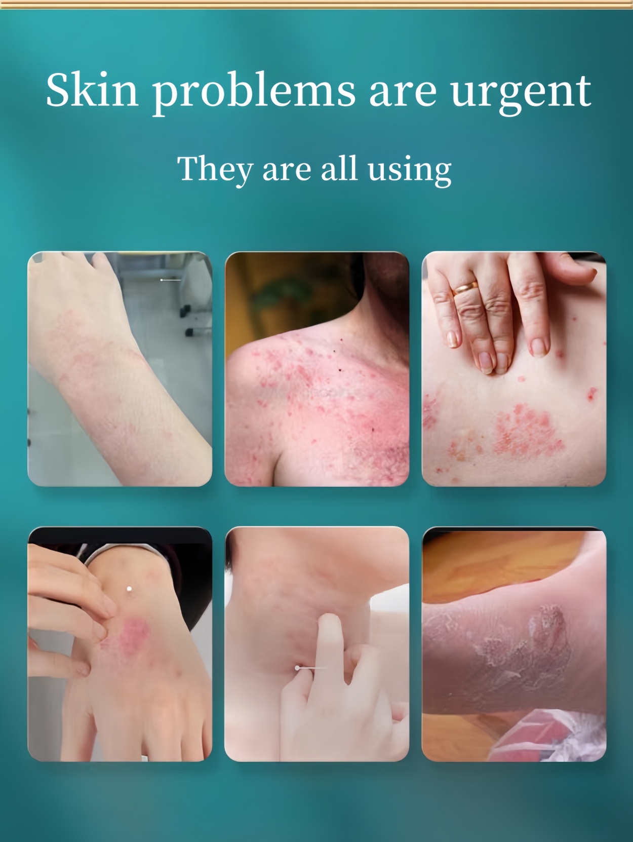 Chinese Herbal Antipruritic Ointment For The Treatment Of dermatitis ...