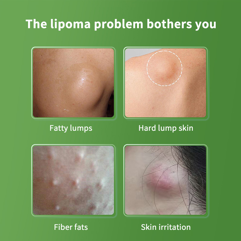 100 % Original Lipoma Removal Cream 脂肪瘤膏20g Removing Lumps in the Body ...