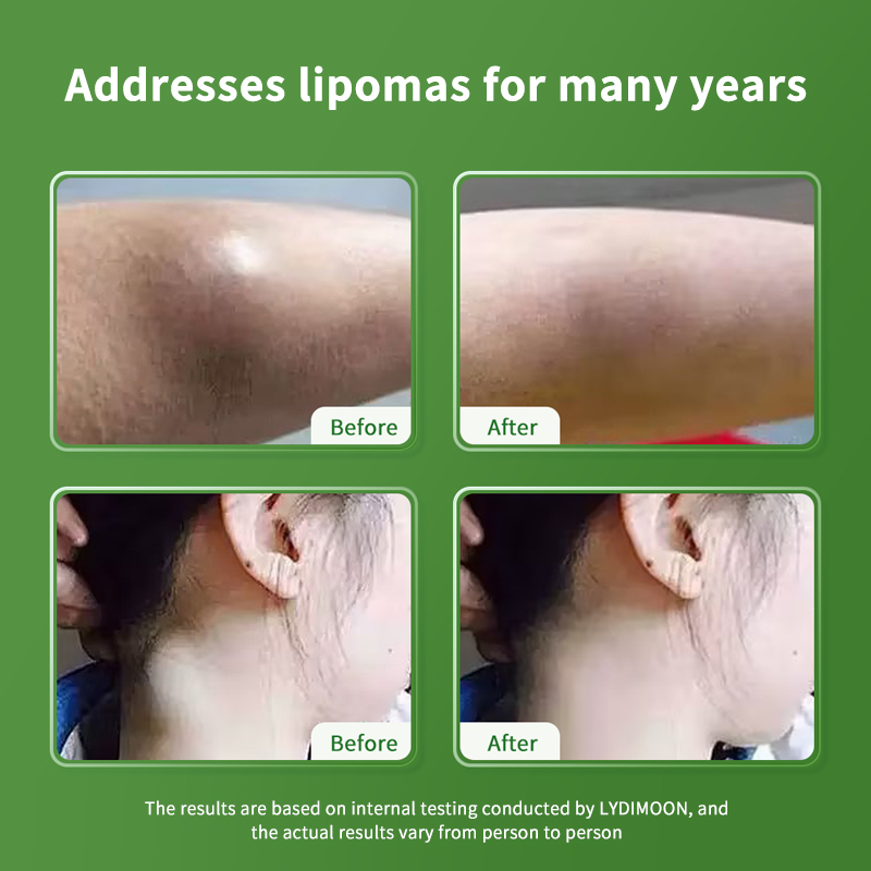 Lipoma Removal Cream Lipolysis Fat Lump Relief Plaster Skin Swelling ...