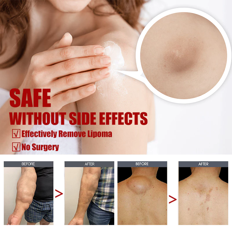 Japan 100% original lipoma removal cream Fatty Cellulite Cream 20g ...