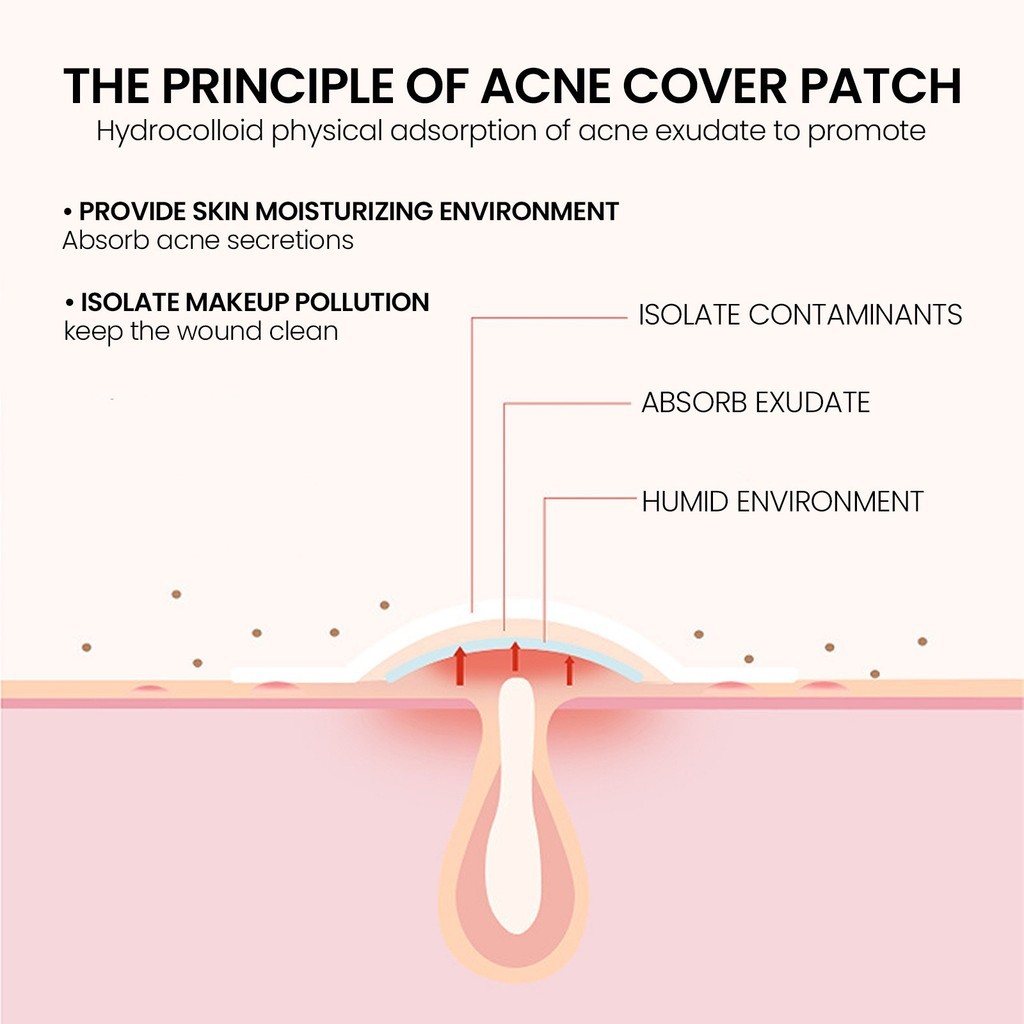 200-Piece Star-Shaped Acne Patches – 5 Color & Multi-Size Hydrocolloid ...