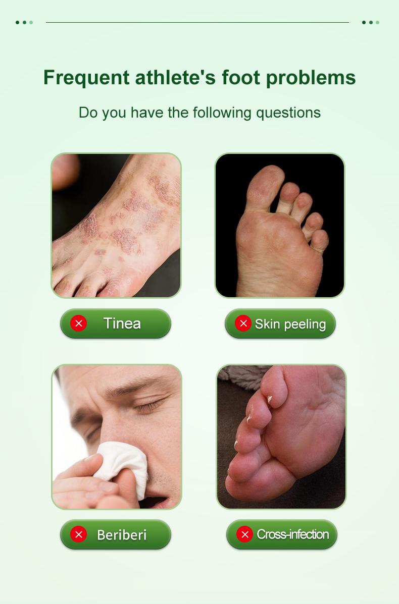Feet deodorant spray 30ml Rapid treatment of fungi and athlete's feet ...